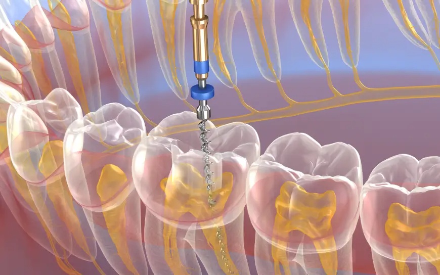 The Advantages of Root Canal Therapy | Houston Cosmetic Dental John H ...