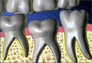Ankylosis on teeth | News | Dentagama