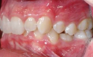 Ankylosis on teeth | News | Dentagama
