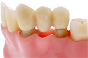 What Are Porcelain Fixed Bridges | Crawford and O brein | Dentagama