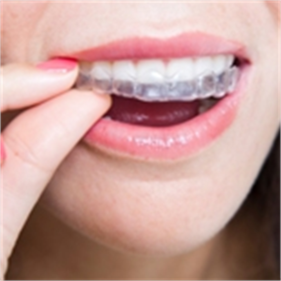 Invisalign | Dentagama