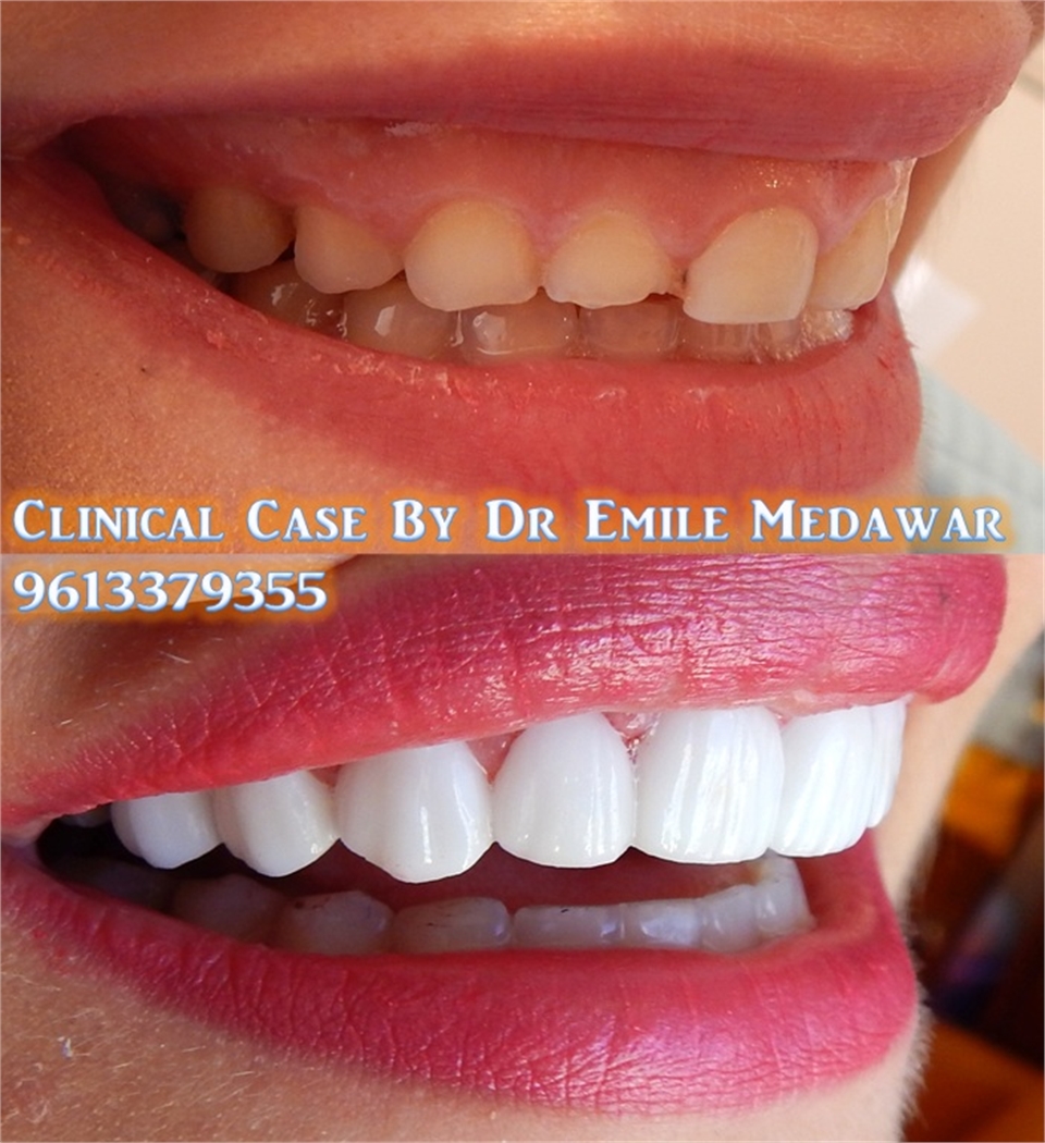 hollywood smile lebanon dental clinic beirut | Dentagama