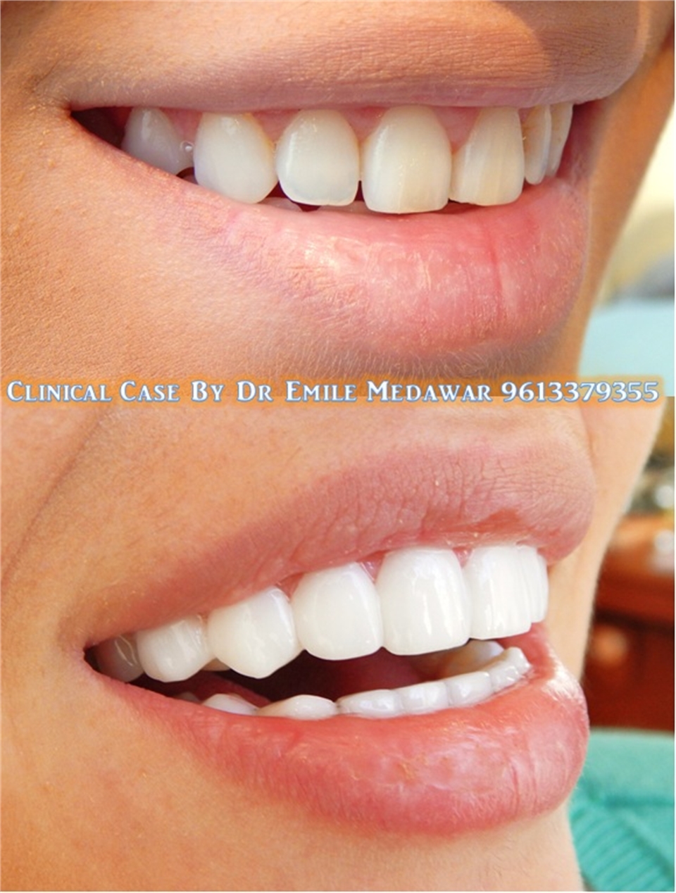 hollywood smile lebanon veneers | Dentagama