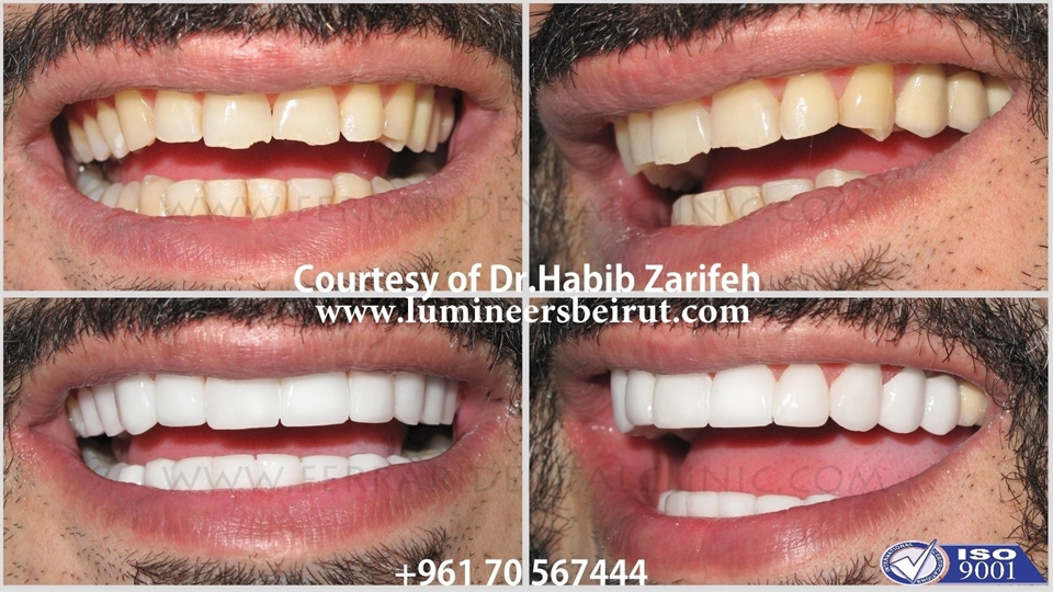 Hollywood smile in Lebanon by Dr Habib Zarifeh | Dentagama