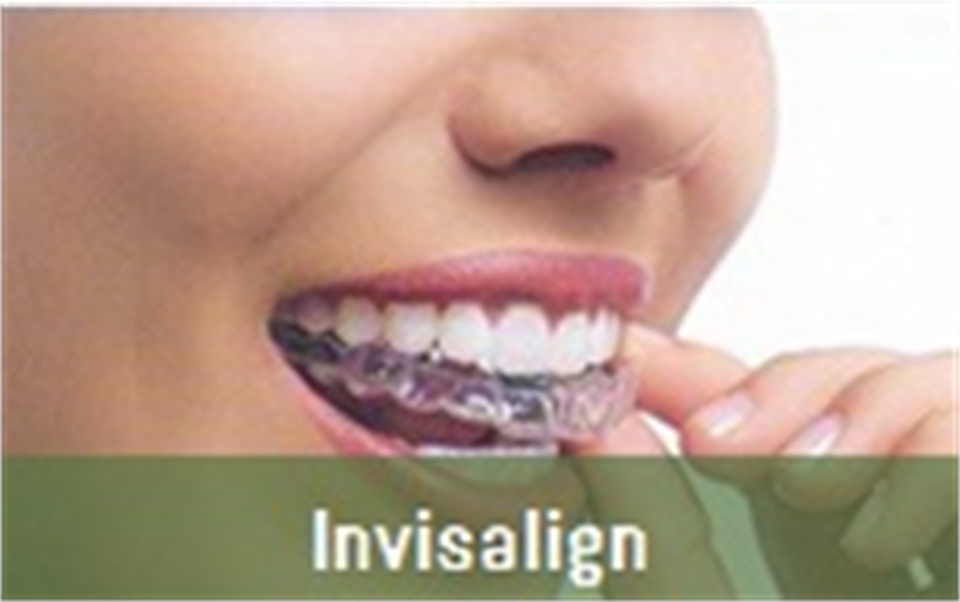 Invisalign | Dentagama
