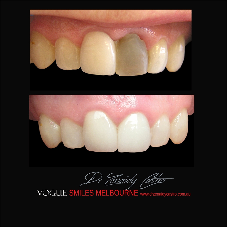 PORCELAIN DENTAL VENEERS SPECIALS AND PACKAGES MELBOURNE CBD -SMILE MAKEOVER BY VOGUE SMILES ...
