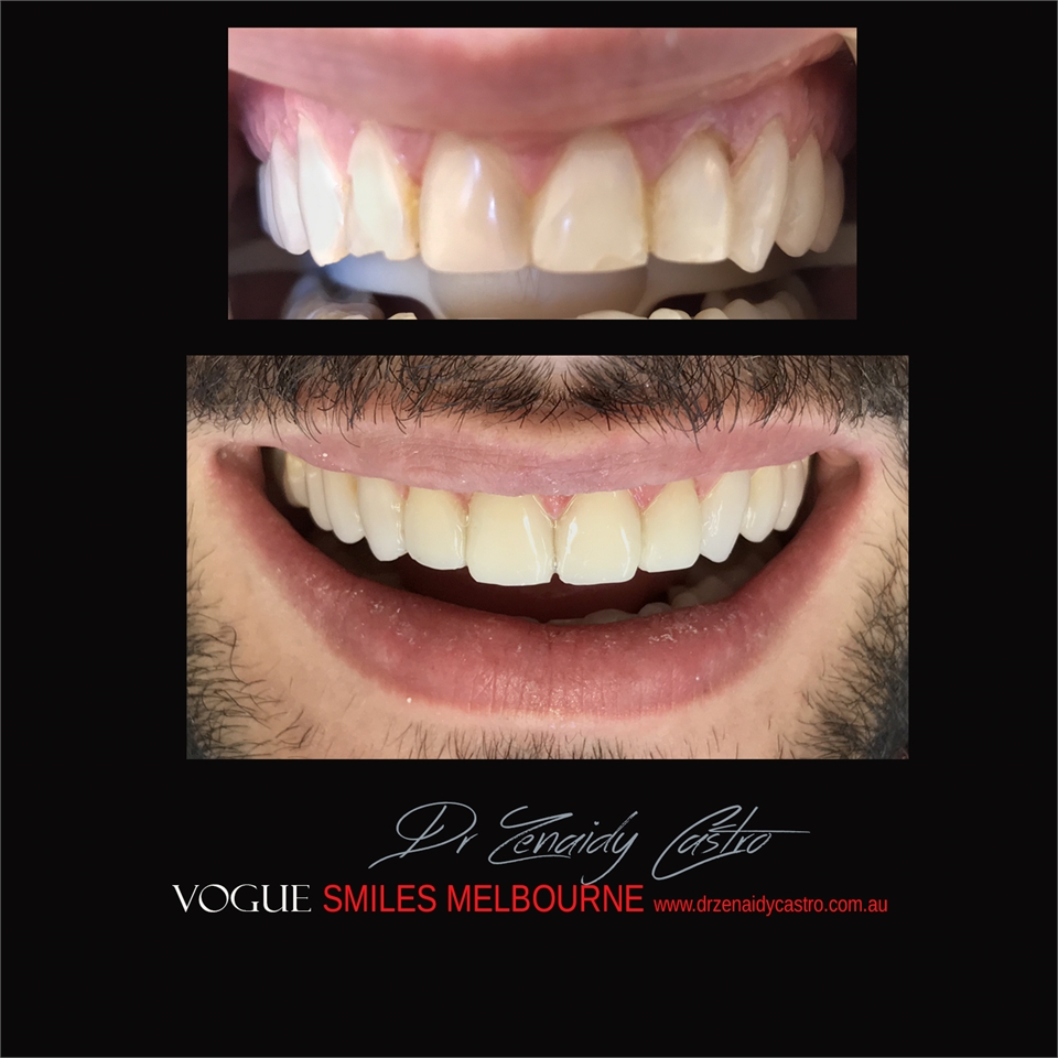 PORCELAIN DENTAL VENEERS SPECIALS AND PACKAGES MELBOURNE CBD -SMILE MAKEOVER BY VOGUE SMILES ...